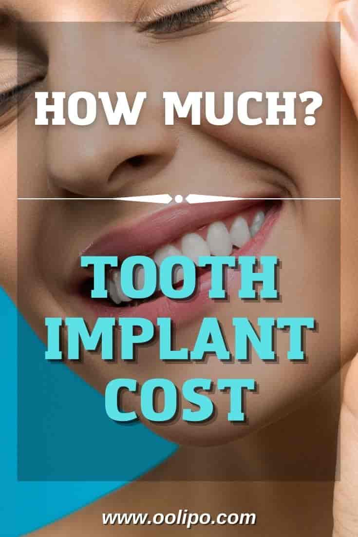 How Much Do Dental Implants Cost? (Price Range and Average) - oolipo
